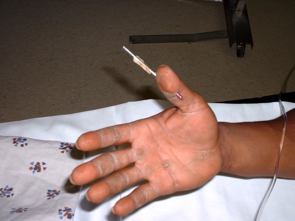 Ask the doc: How to handle impalement injuries - RevZilla